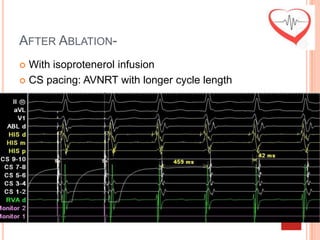 Case Presentataion-psvt | PPTX | Thyroid Disorders | Endocrine and ...