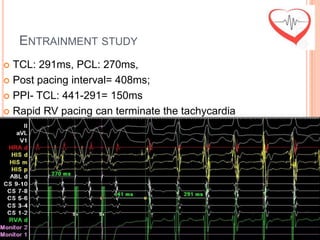 Case Presentataion-psvt | PPTX | Thyroid Disorders | Endocrine and ...