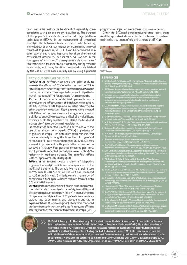 Using Botox for trigeminal neuralgia | PDF