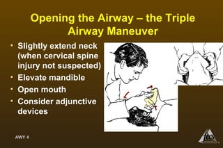 Airway management | PPT