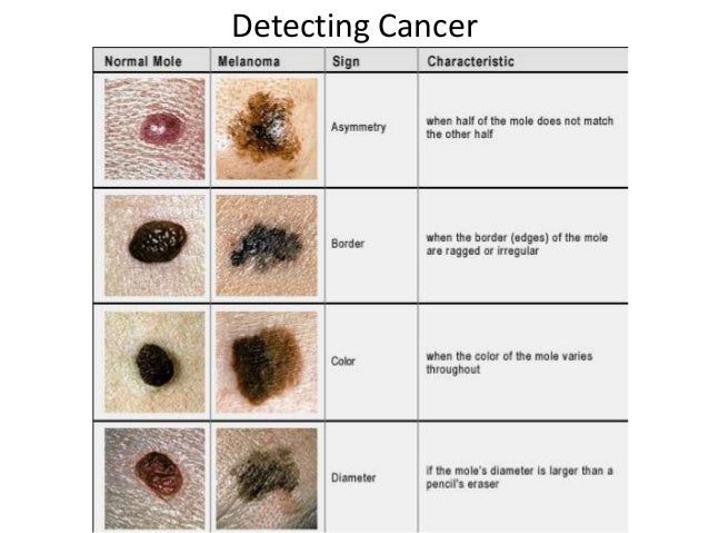 04 cancer