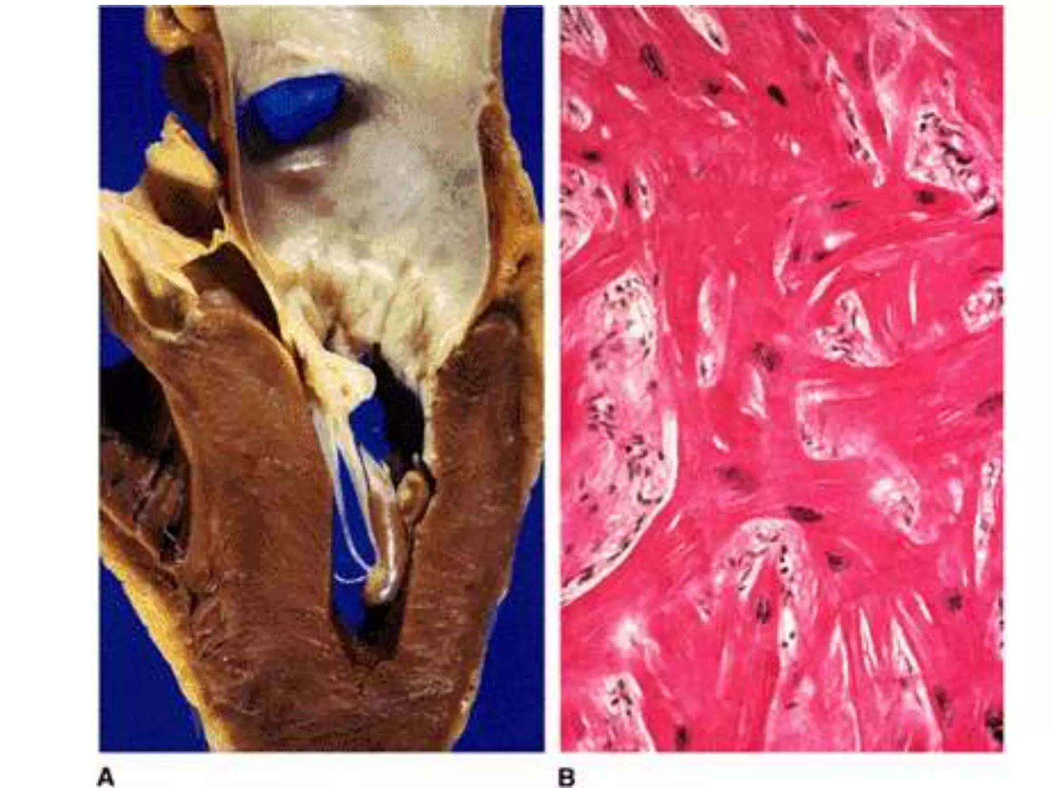 04 cardiac pathology | PPT