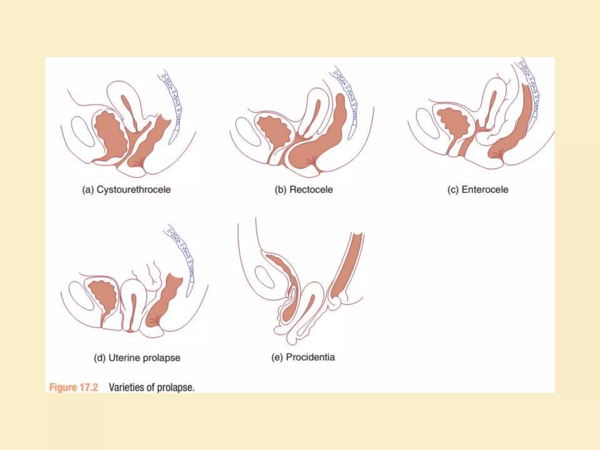 04 genital prolapse isam | PPTX | Pregnancy | Reproductive Health
