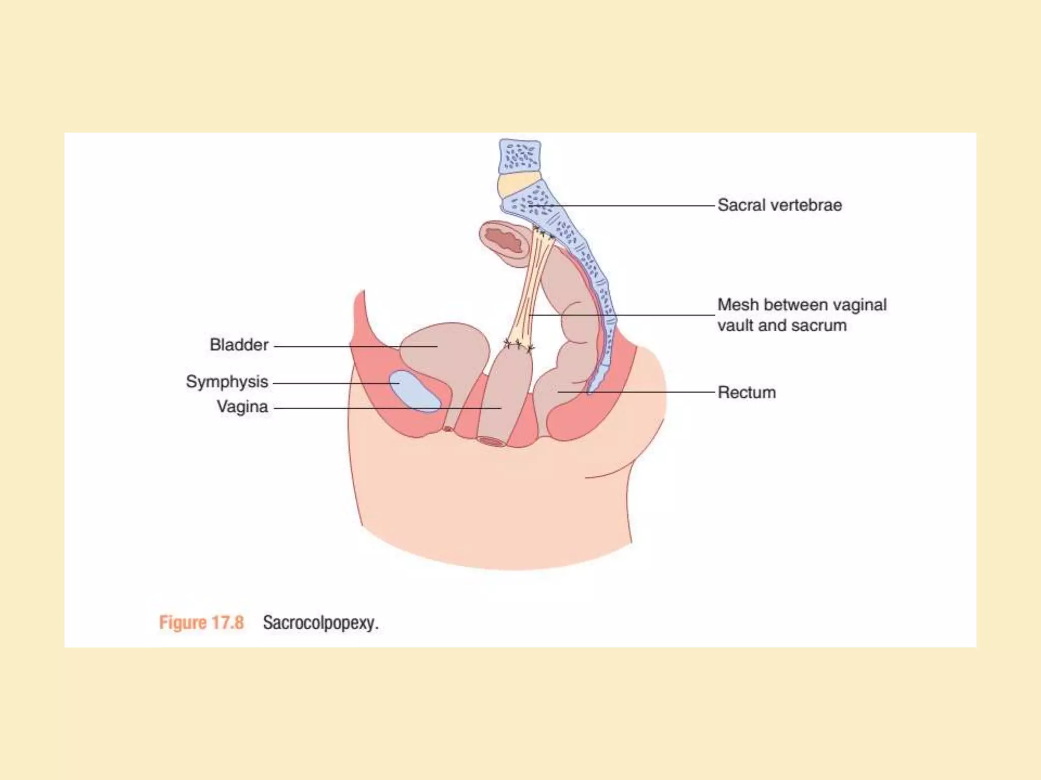 04 genital prolapse isam | PPTX | Pregnancy | Reproductive Health