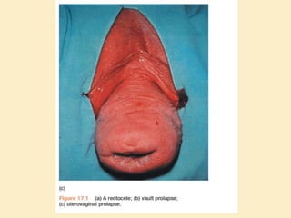 04 genital prolapse isam | PPTX | Pregnancy | Reproductive Health