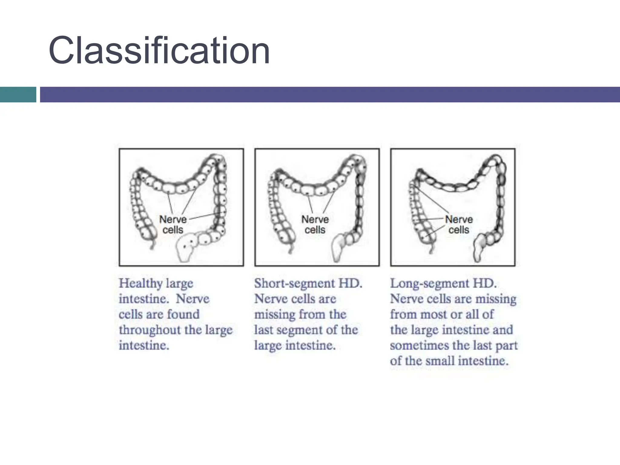 Hirschsprung's Disease and management.ppt