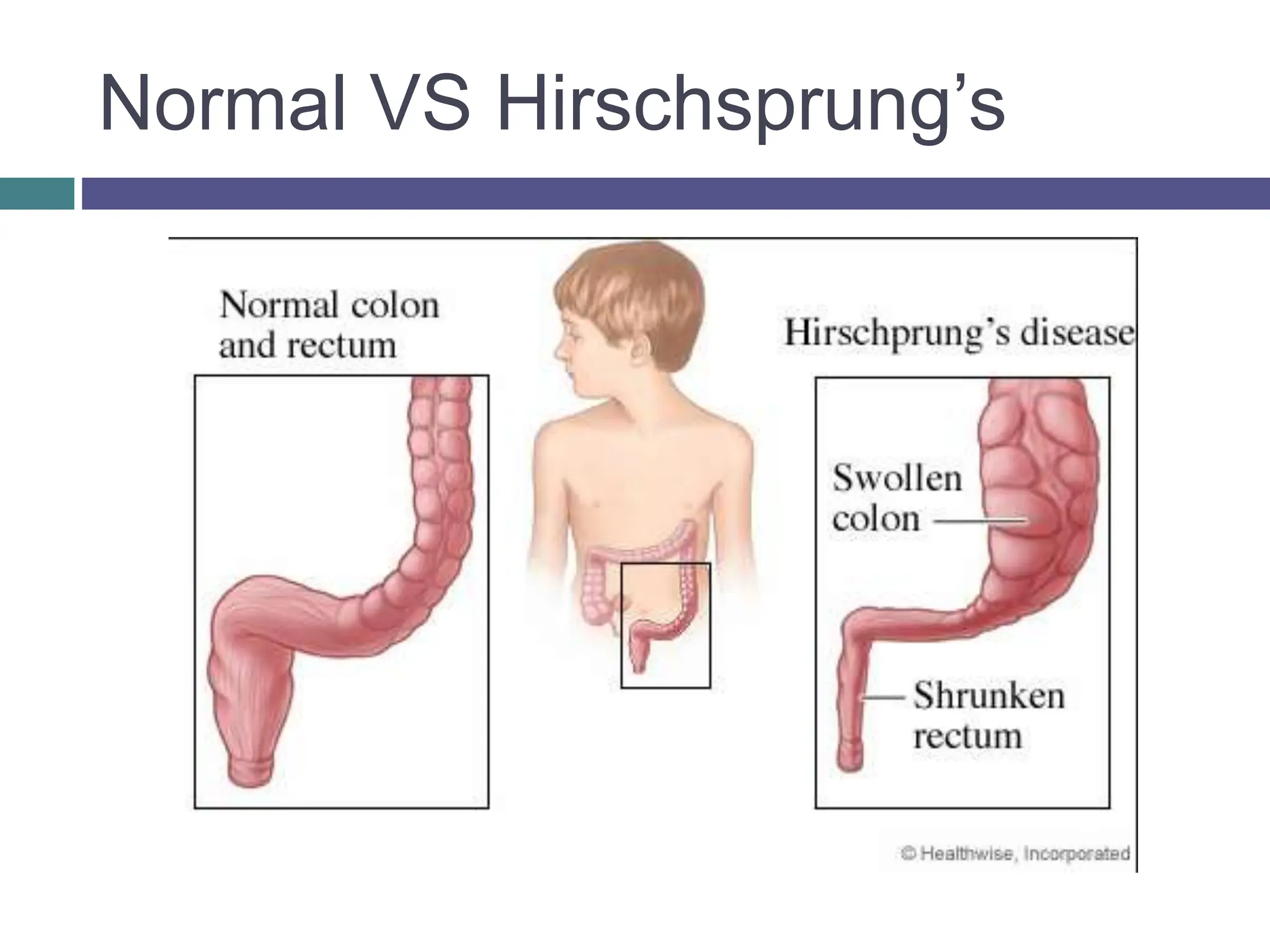 Hirschsprung's Disease and management.ppt