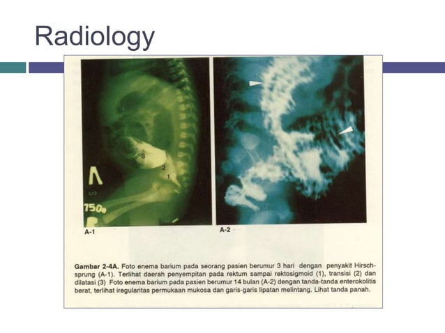 Hirschsprung's Disease and management.ppt