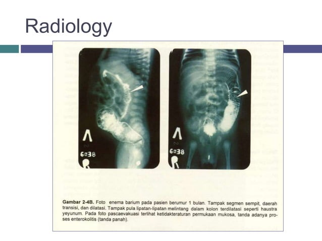 Hirschsprung's Disease and management.ppt