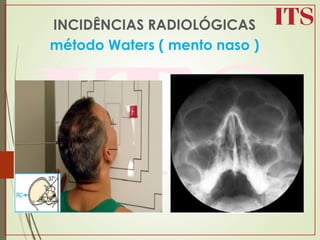 04 POSICIONAMENTOS DOS OSSOS DA FACE.pdf