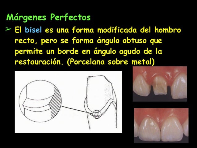 04 protesis fija preparaciones dentarias-(dr._tipismana)alas