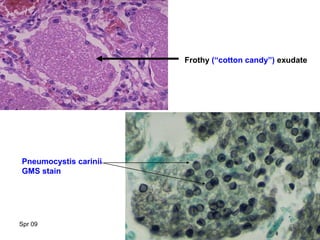 04 respiratory infection2 | PPT