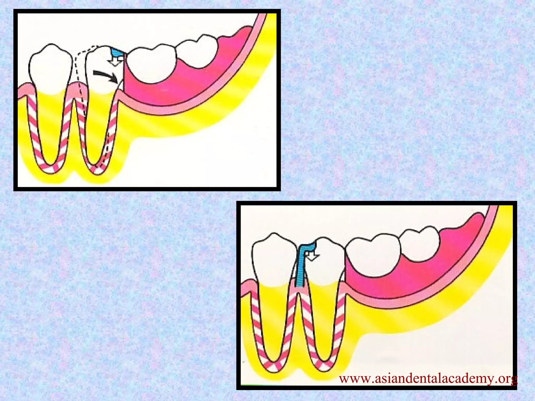 Rests & Rest seats in removable partial Dentures | PPT