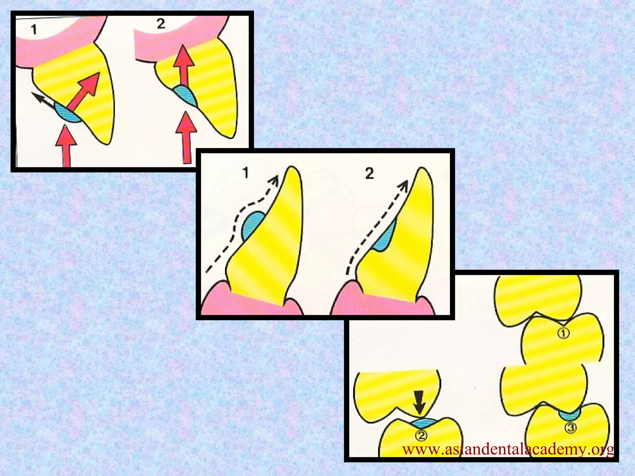 Rests & Rest seats in removable partial Dentures | PPT
