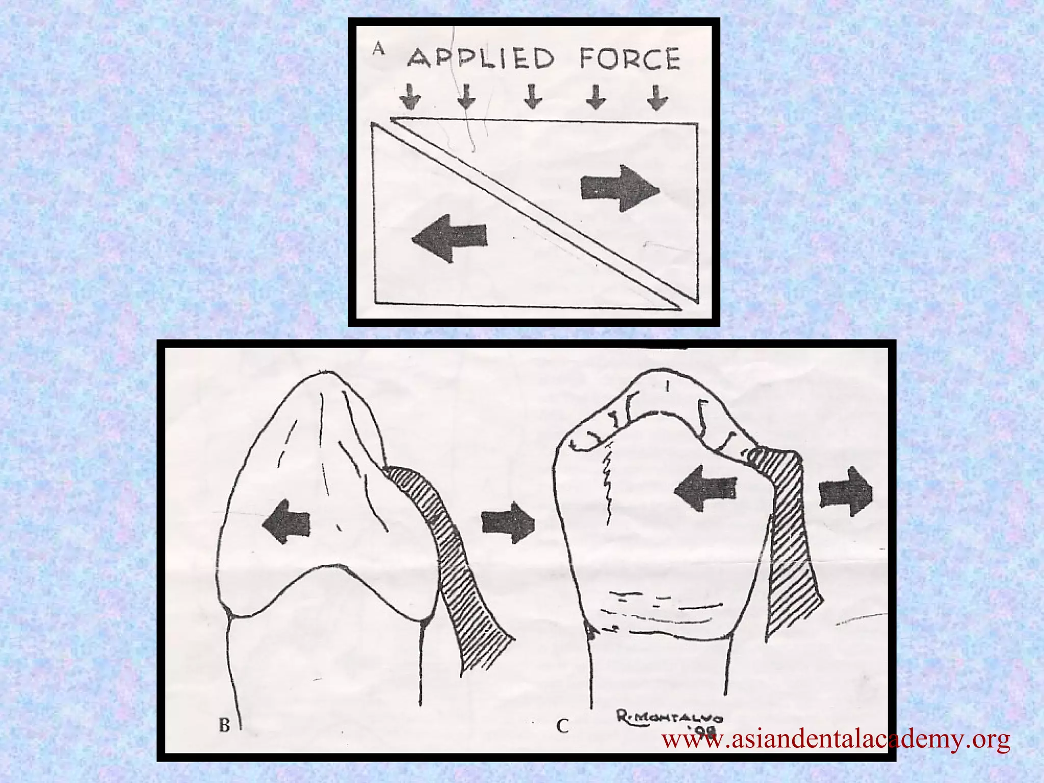 Rests & Rest seats in removable partial Dentures | PPT