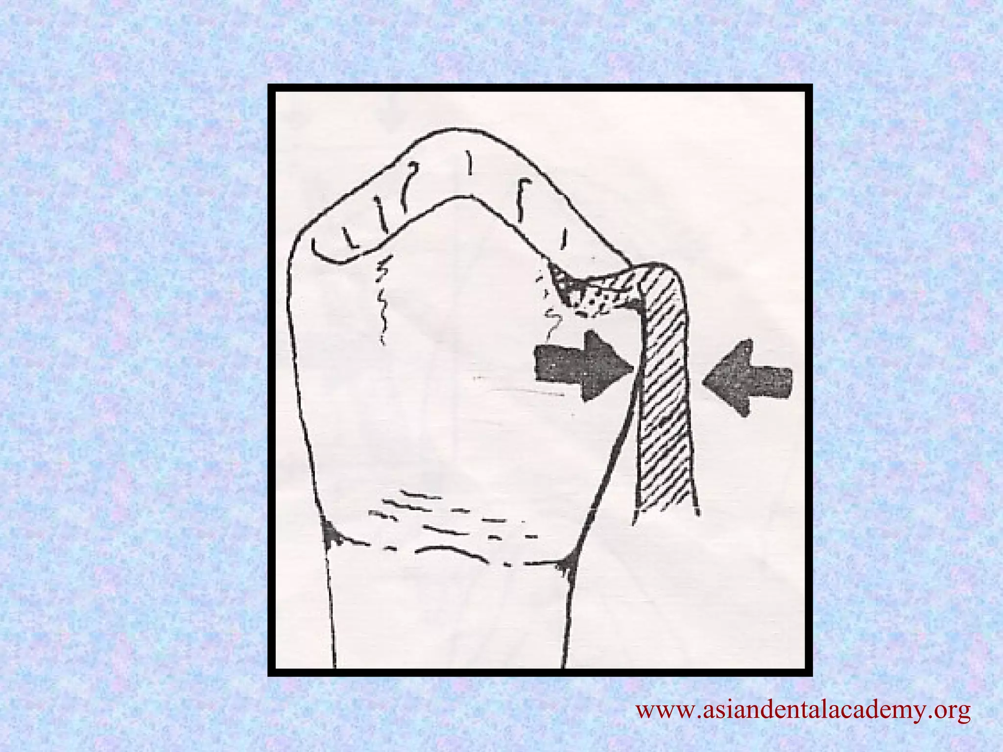 Rests & Rest seats in removable partial Dentures | PPT