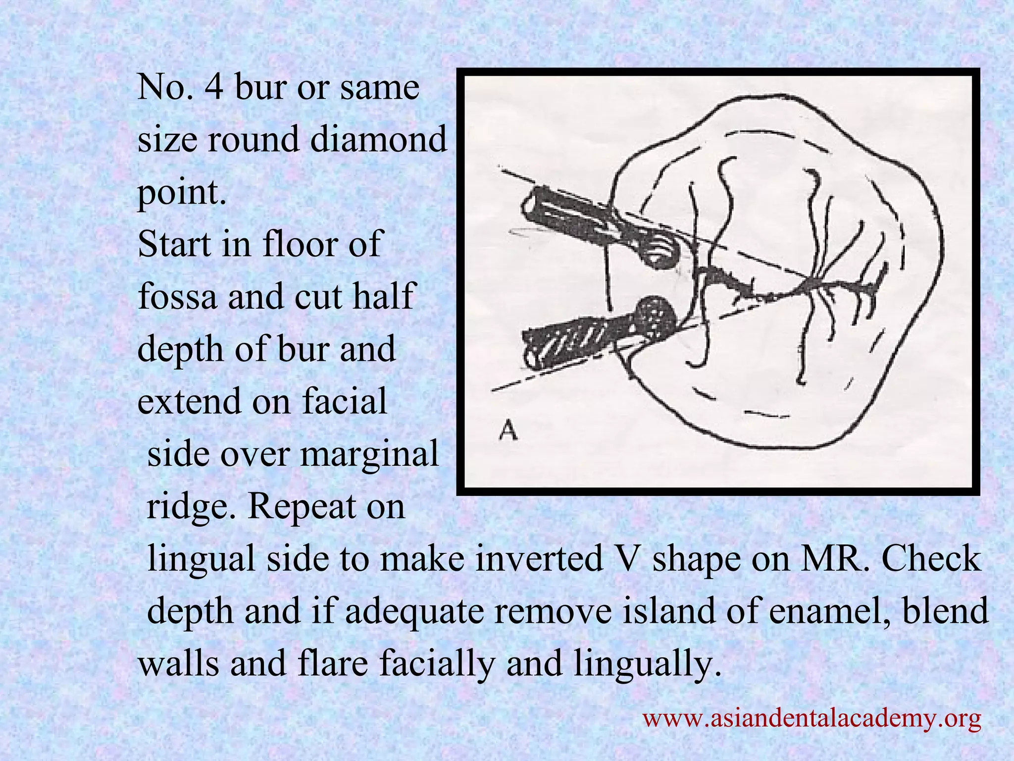 Rests & Rest seats in removable partial Dentures | PPT