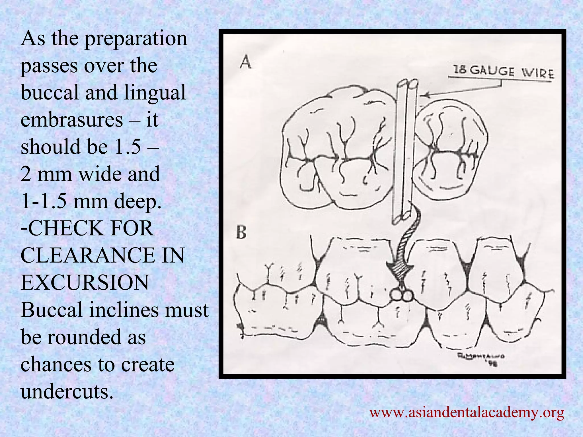 Rests & Rest seats in removable partial Dentures | PPT