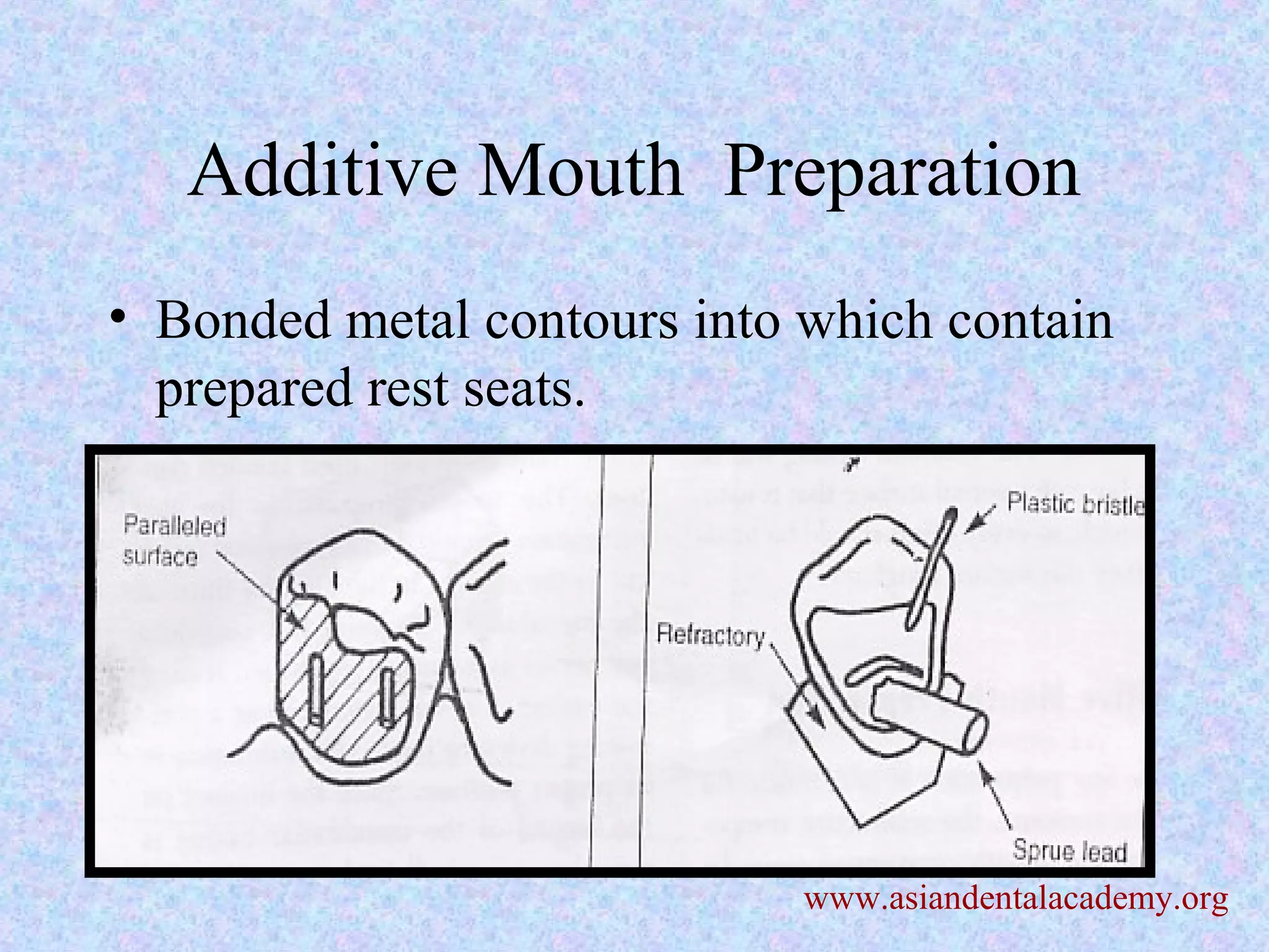Rests & Rest seats in removable partial Dentures | PPT