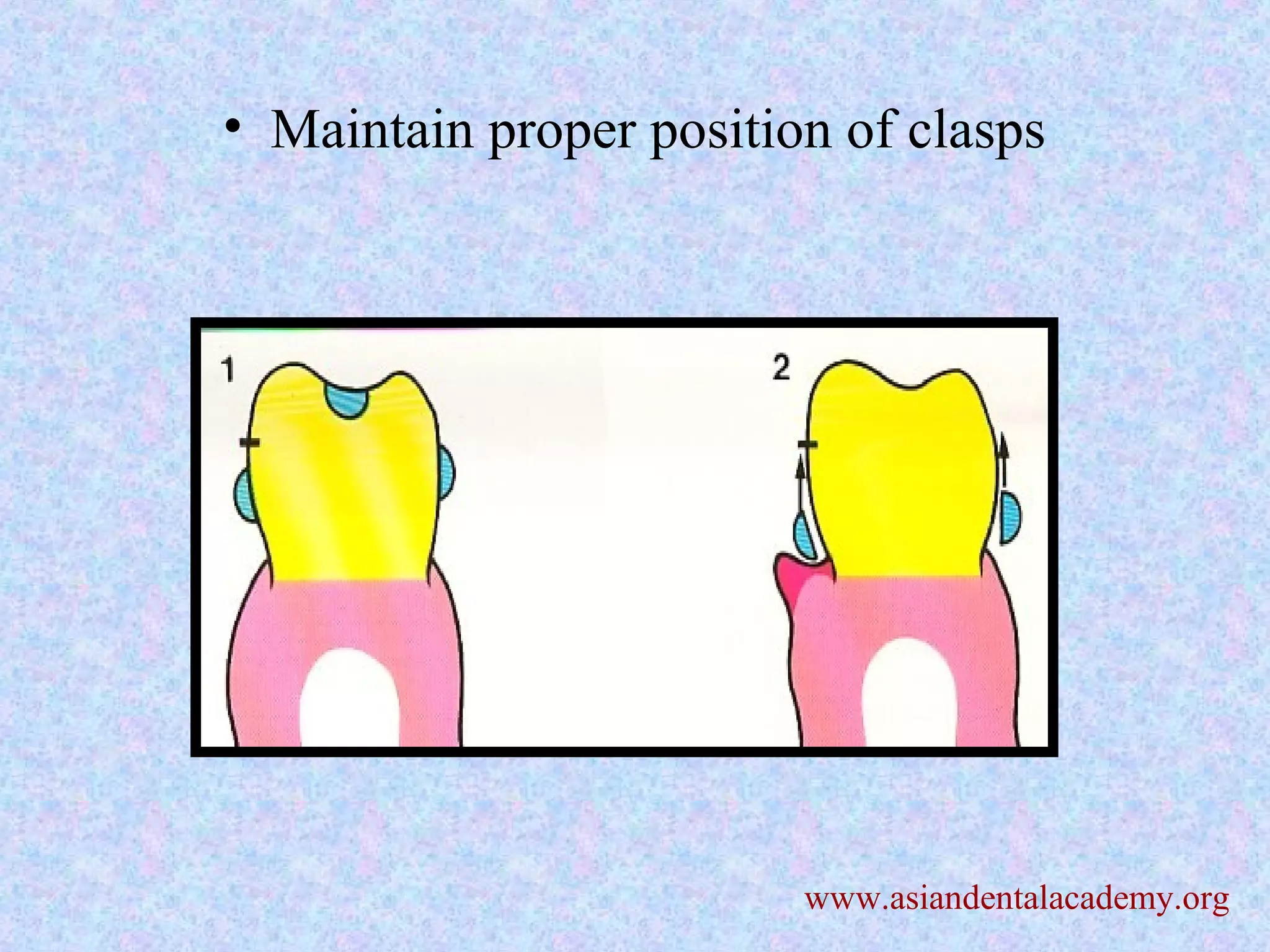 Rests & Rest seats in removable partial Dentures | PPT