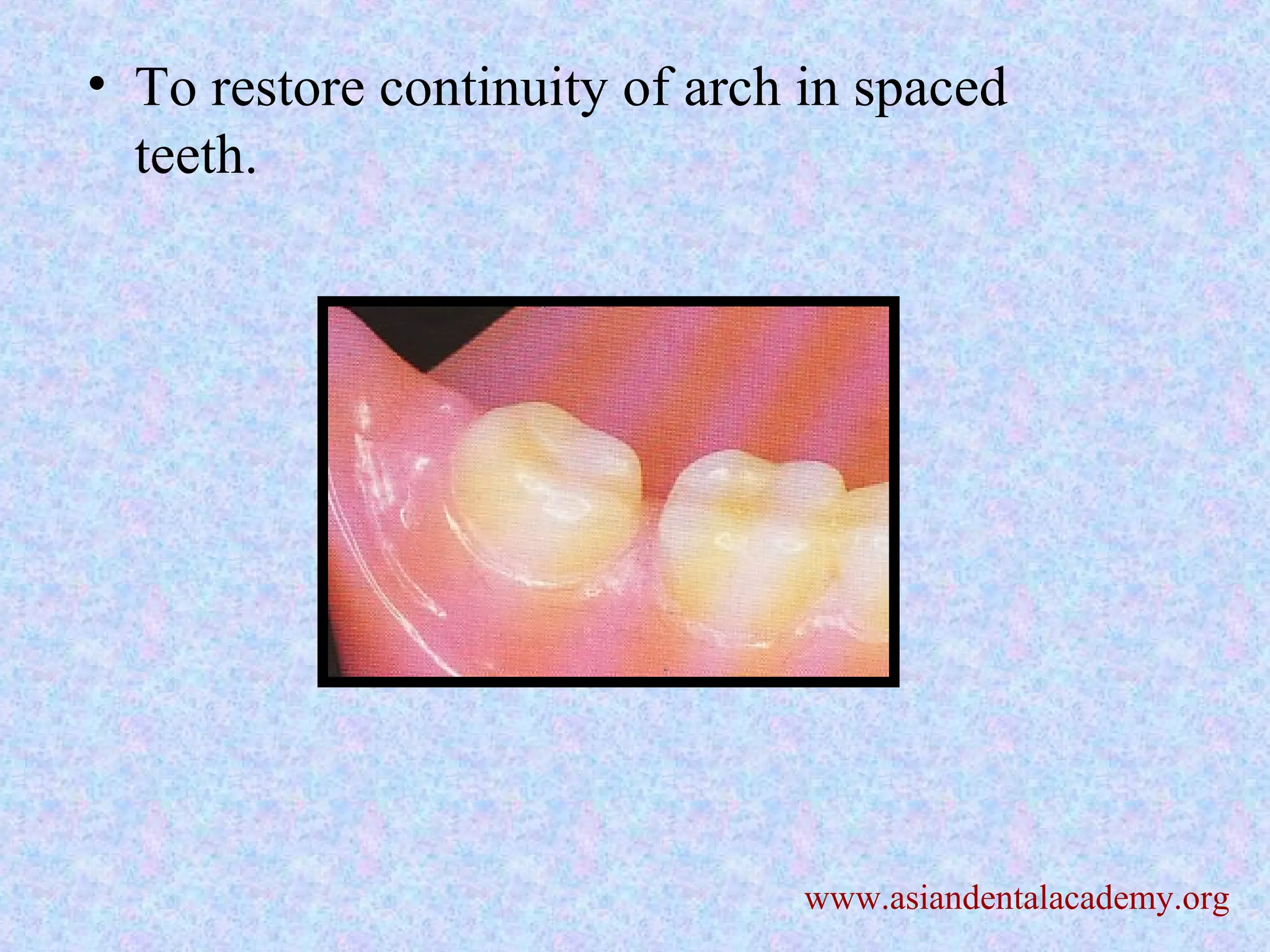 Rests & Rest seats in removable partial Dentures | PPT