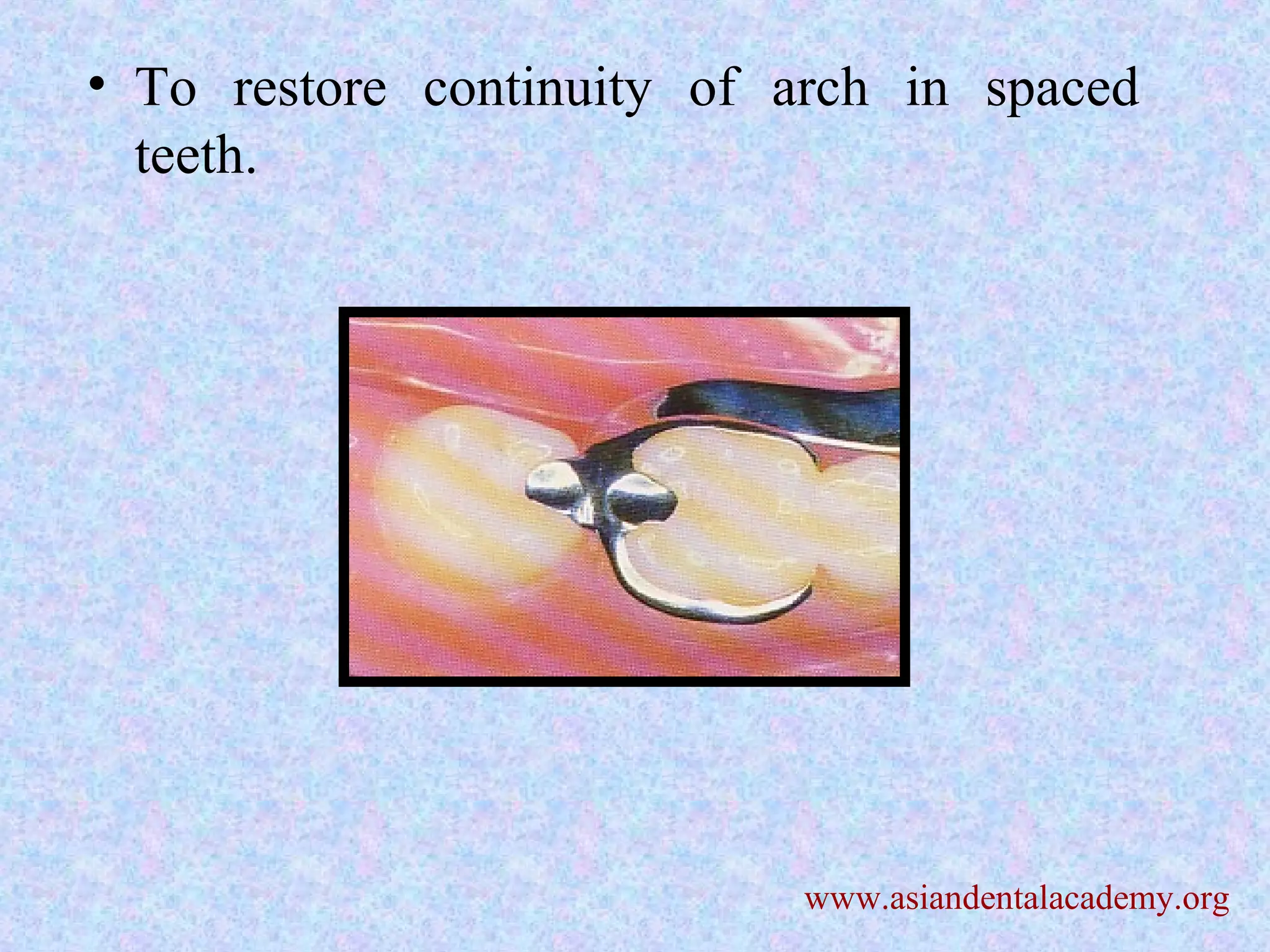 Rests & Rest seats in removable partial Dentures | PPT