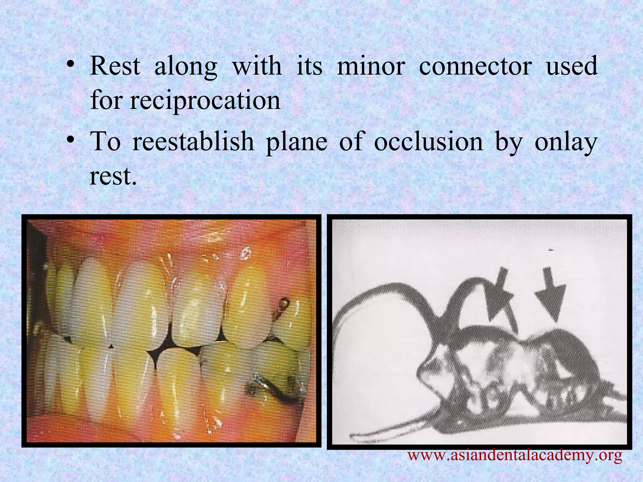 Rests & Rest seats in removable partial Dentures | PPT