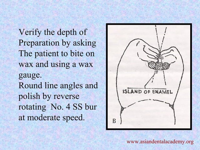 Rests & Rest seats in removable partial Dentures | PPT