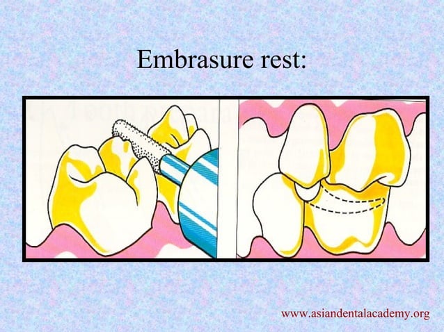 Rests & Rest seats in removable partial Dentures | PPT