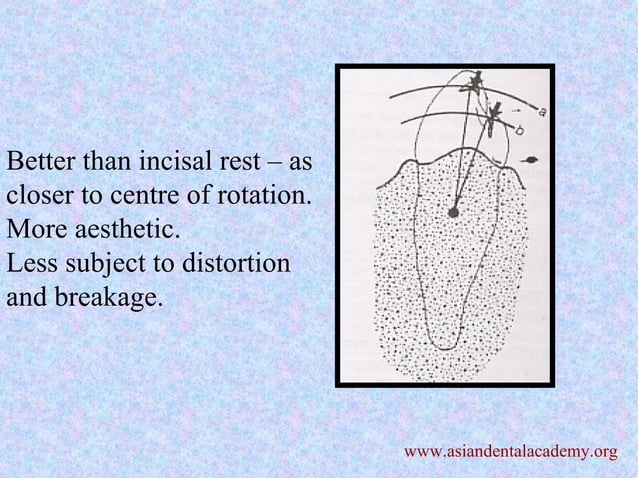 Rests & Rest seats in removable partial Dentures | PPT