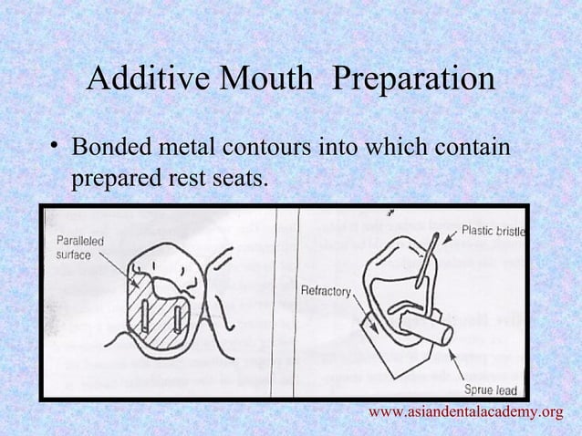 Rests & Rest seats in removable partial Dentures | PPT