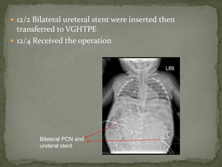 04 retroperitoneal teratoma final | PPT