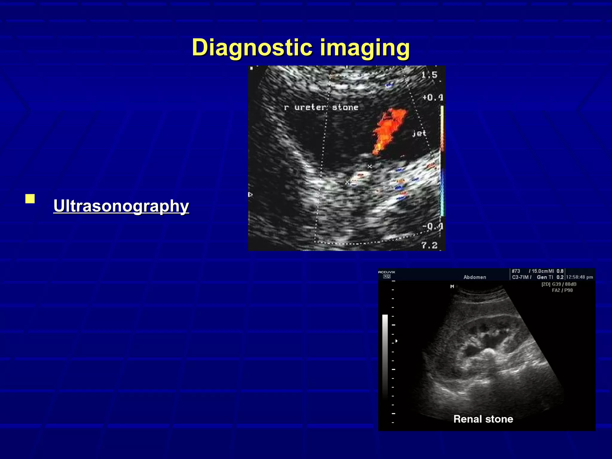 Urinary Stones Disease - Urolithiasis | PPT