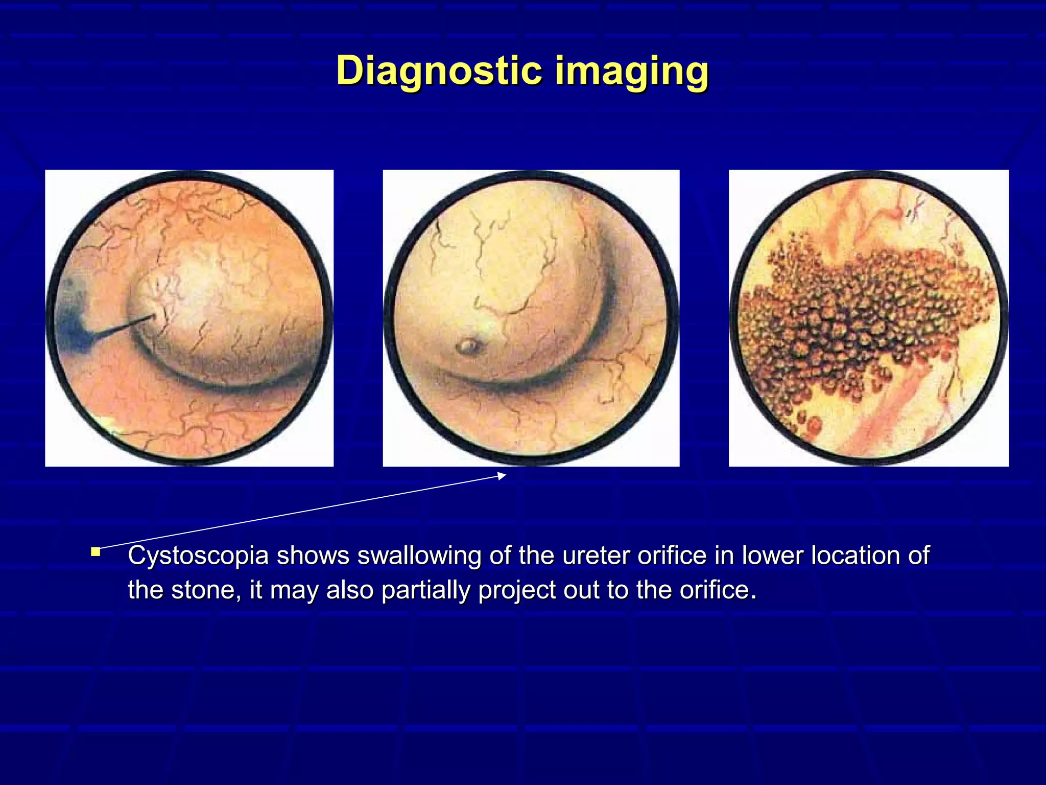 Urinary Stones Disease - Urolithiasis | PPT