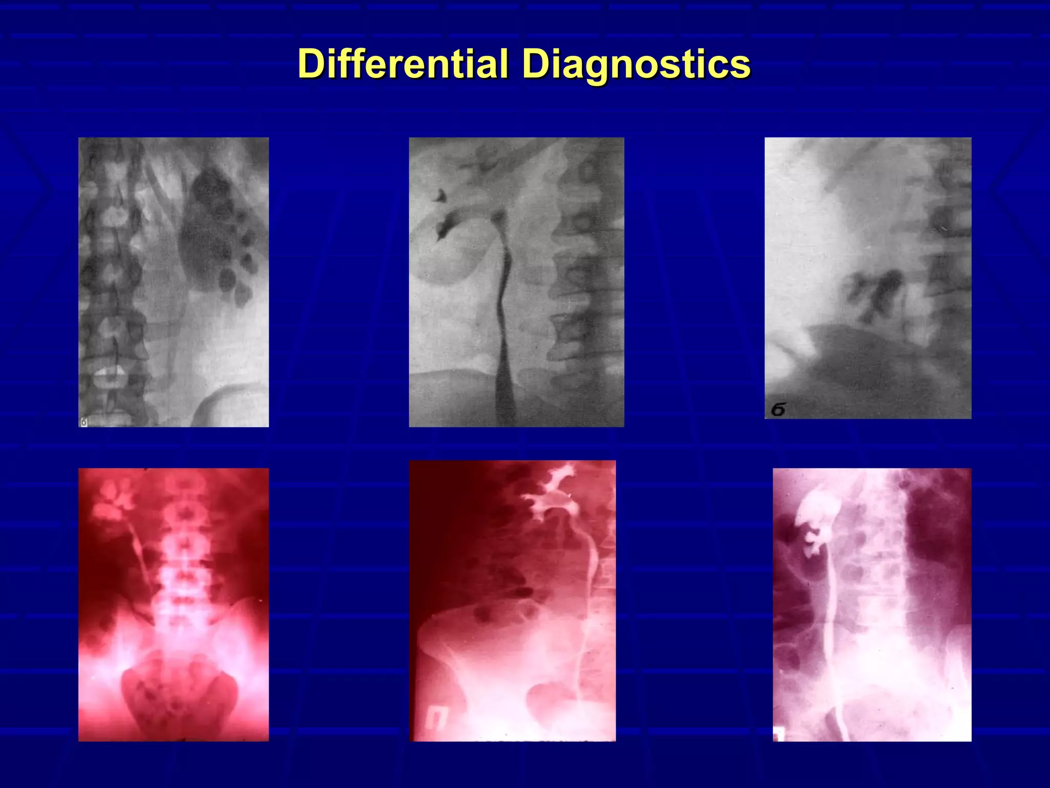 Urinary Stones Disease - Urolithiasis | PPT