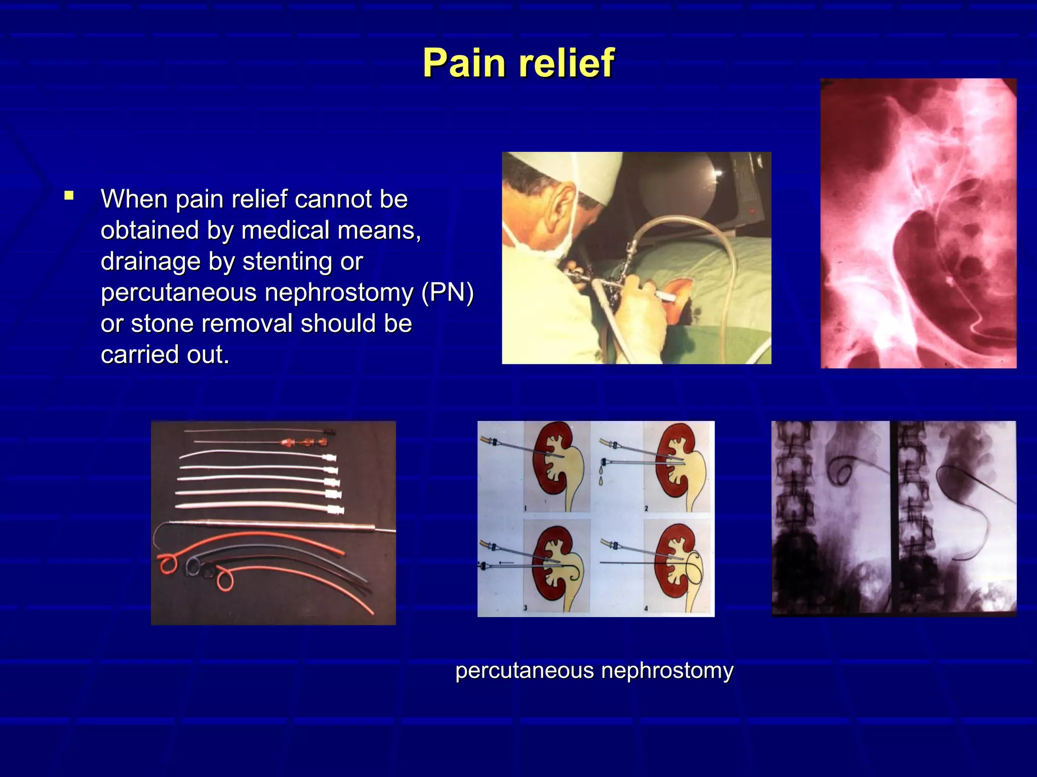 Urinary Stones Disease - Urolithiasis | PPT