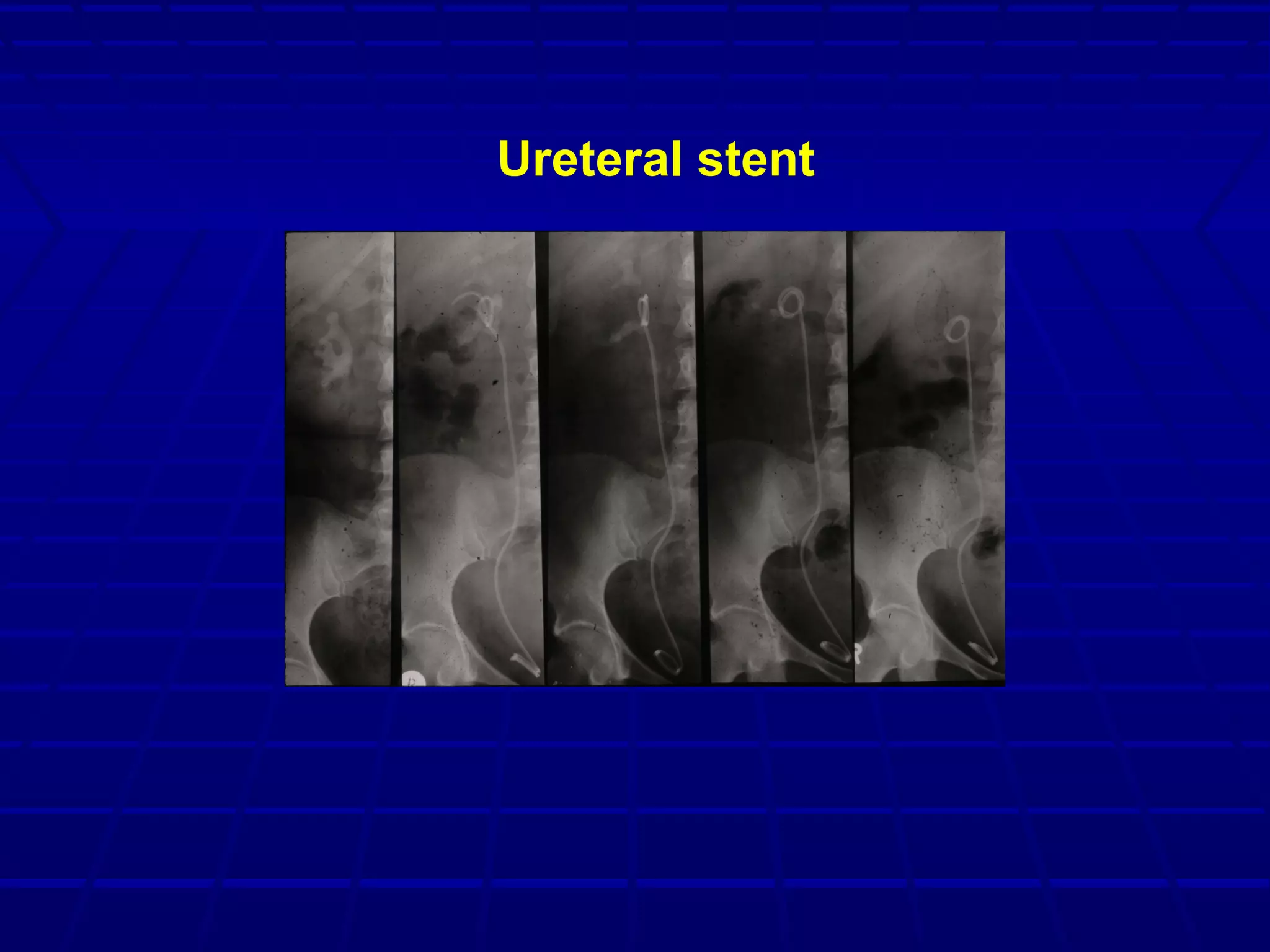 Urinary Stones Disease - Urolithiasis | PPT