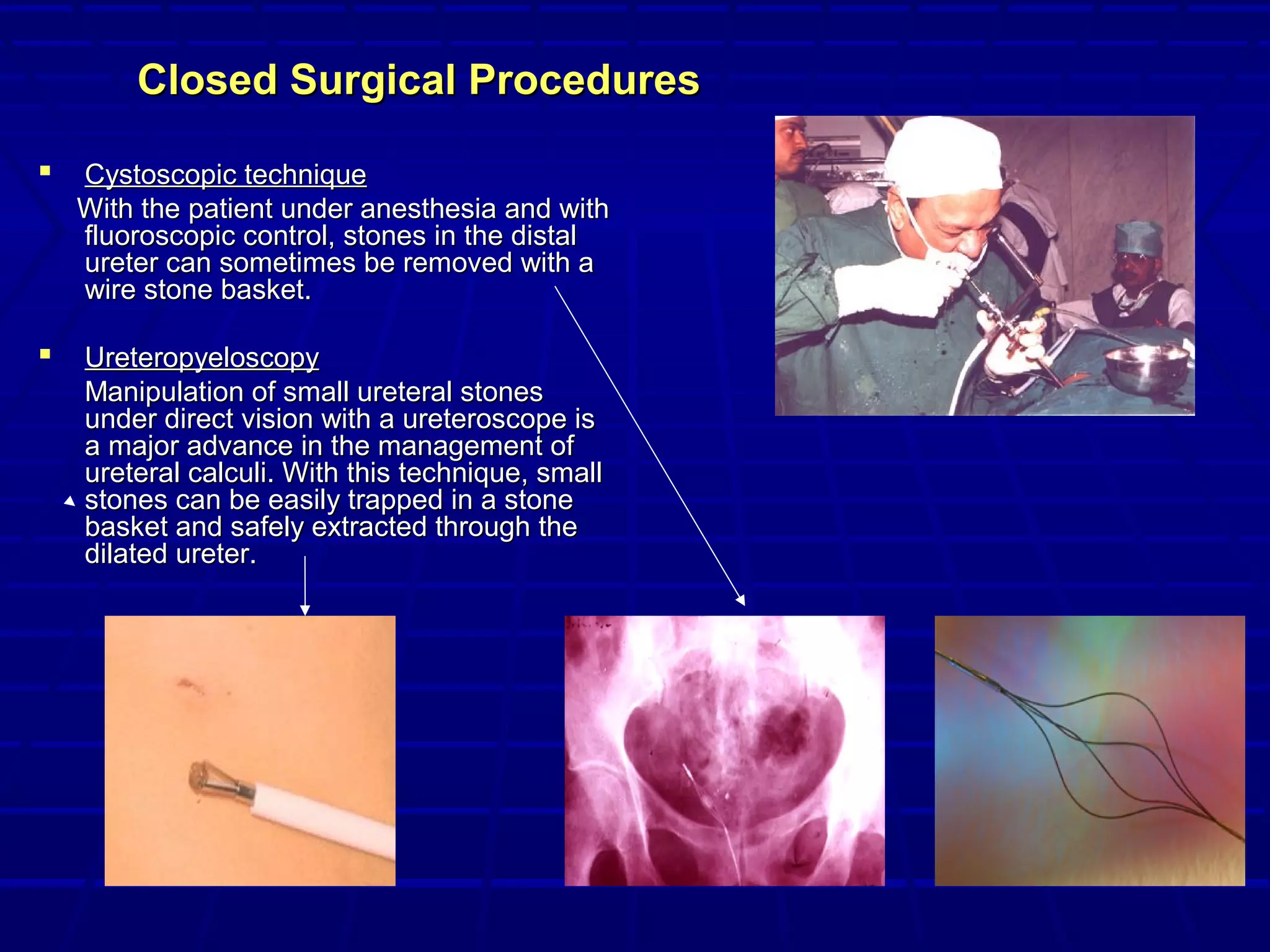 Urinary Stones Disease - Urolithiasis | PPT