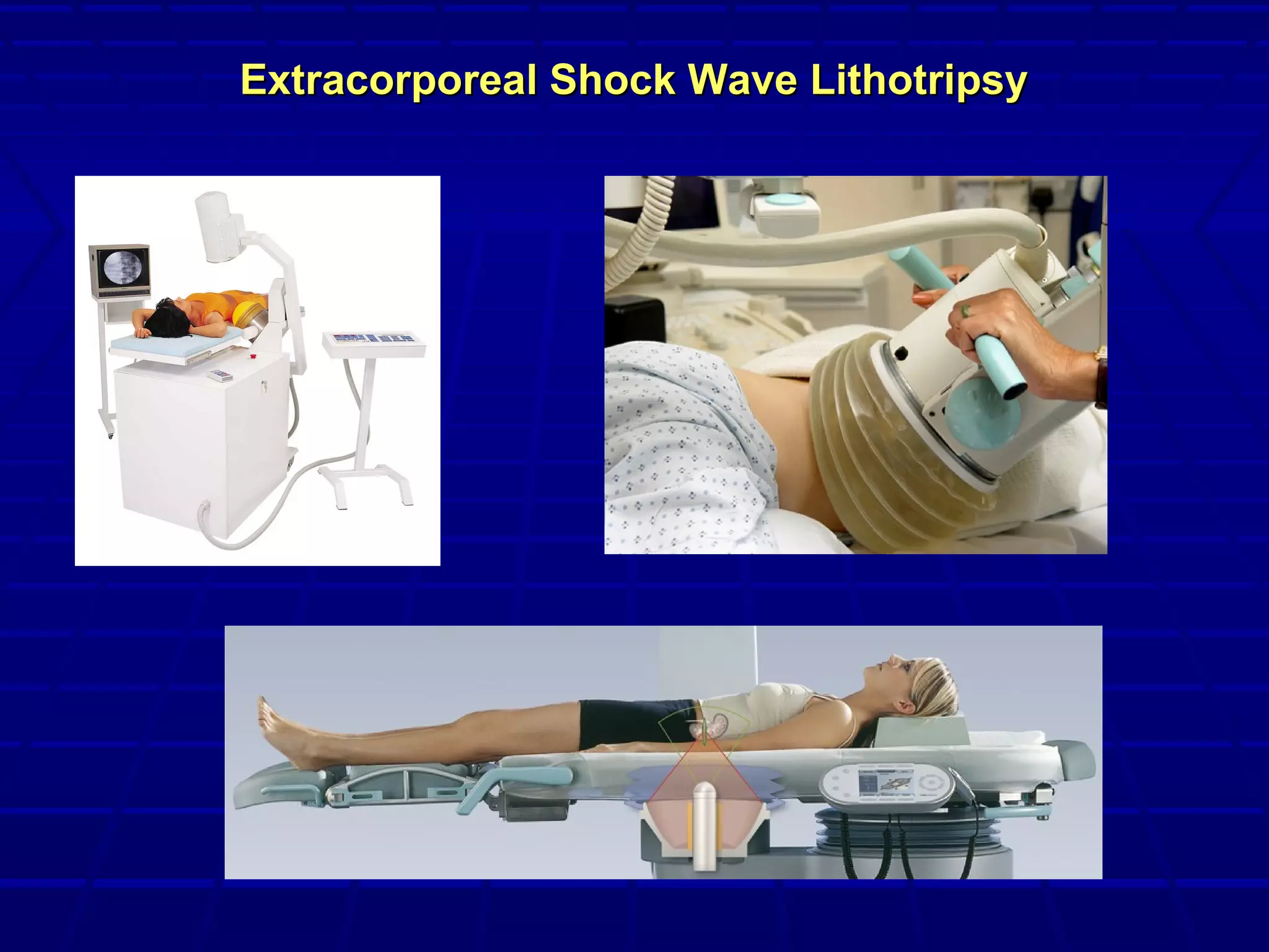 Urinary Stones Disease - Urolithiasis | PPT