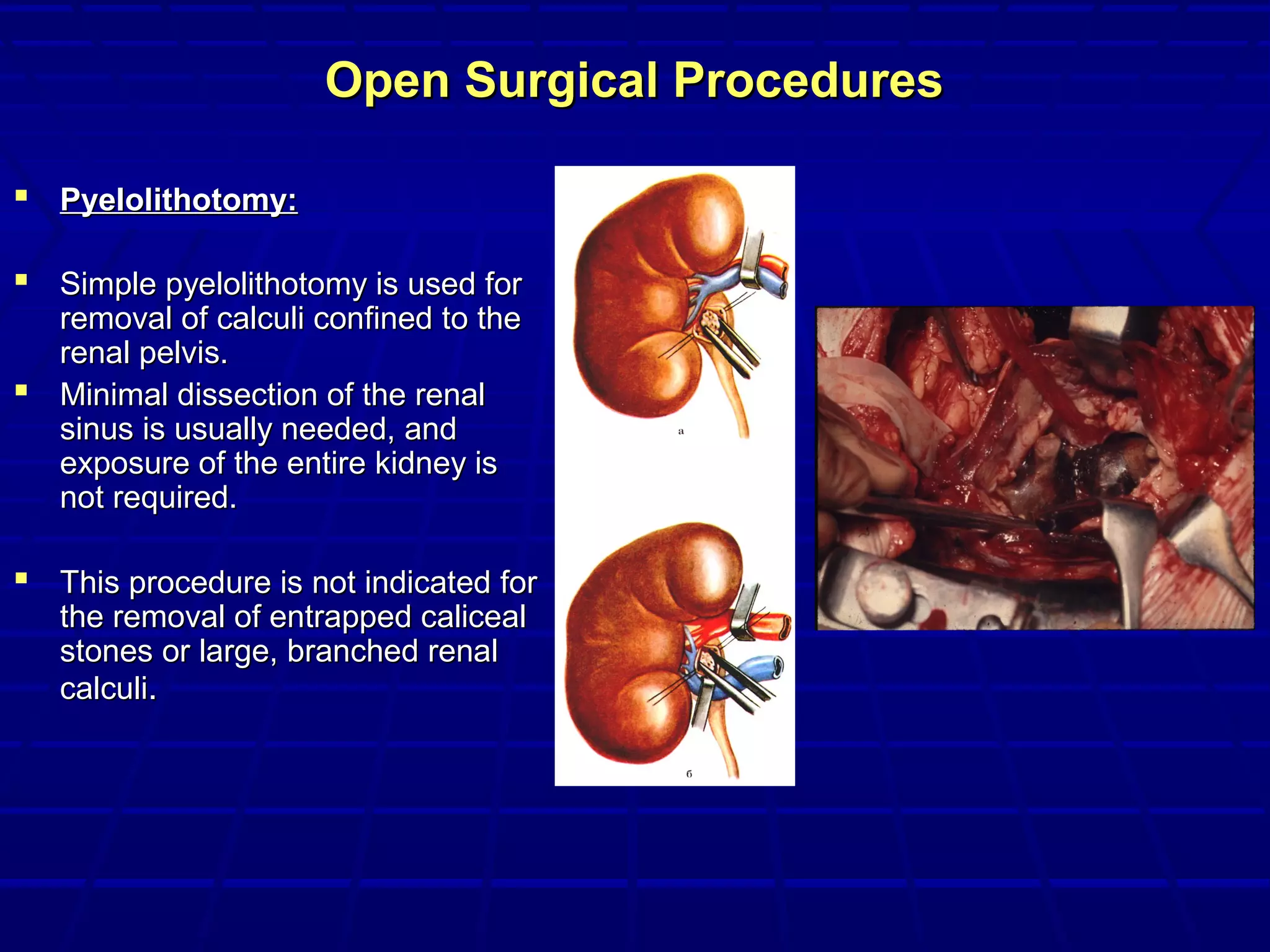 Urinary Stones Disease - Urolithiasis | PPT