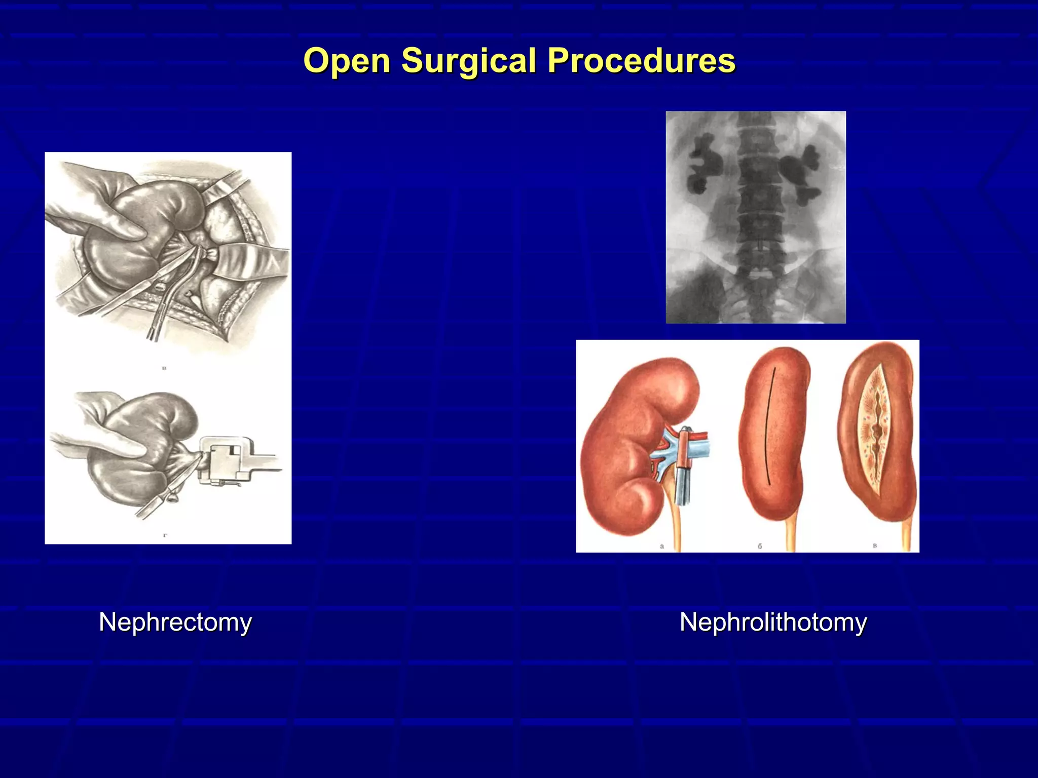 Urinary Stones Disease - Urolithiasis | PPT