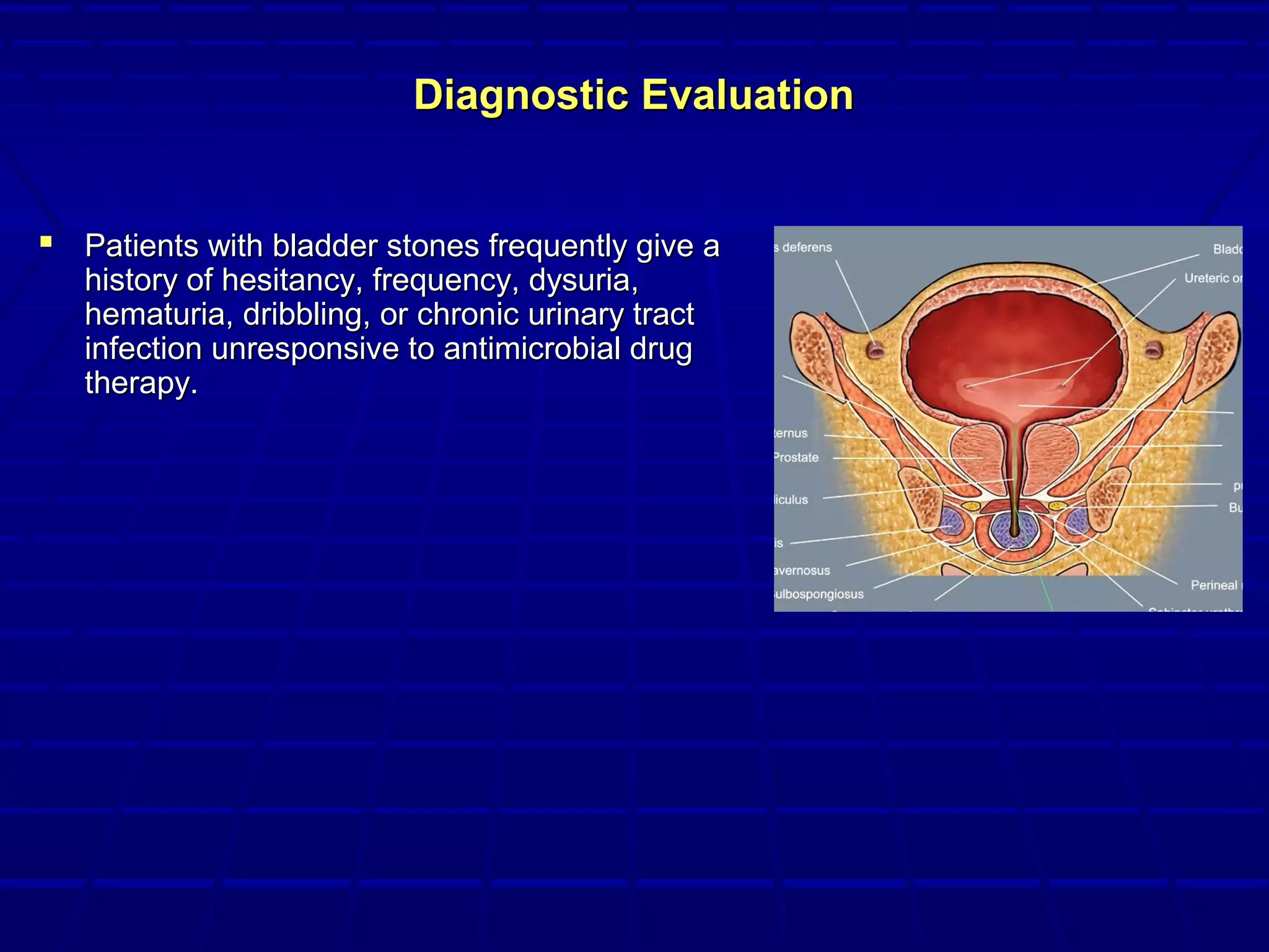 Urinary Stones Disease - Urolithiasis | PPT