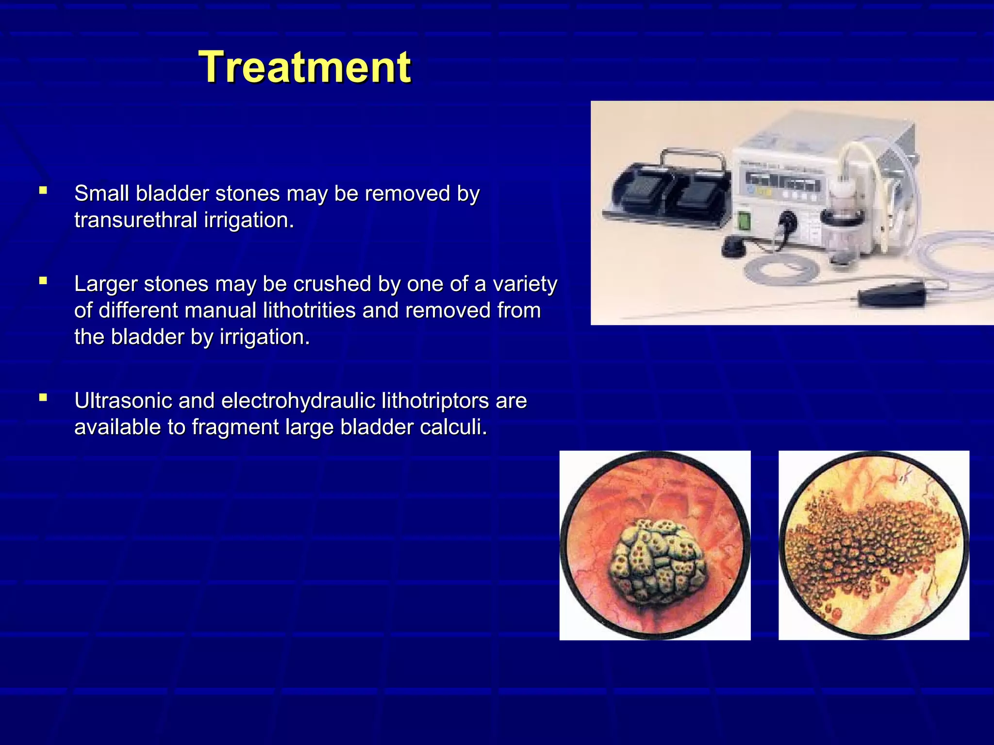 Urinary Stones Disease - Urolithiasis | PPT