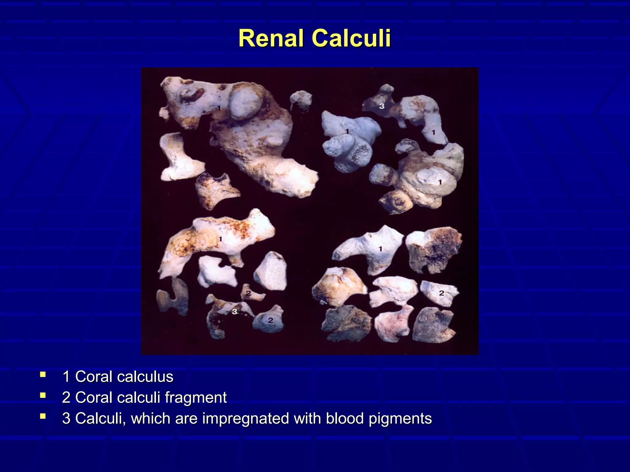 Urinary Stones Disease - Urolithiasis | PPT