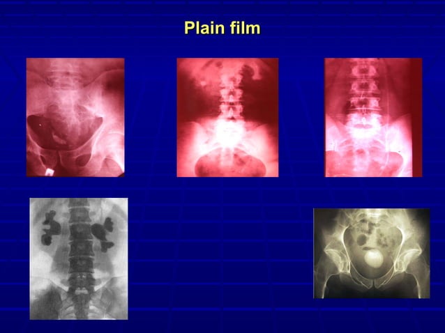 Urinary Stones Disease - Urolithiasis | PPT
