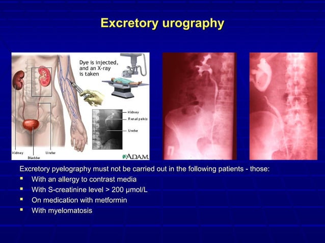 Urinary Stones Disease - Urolithiasis | PPT