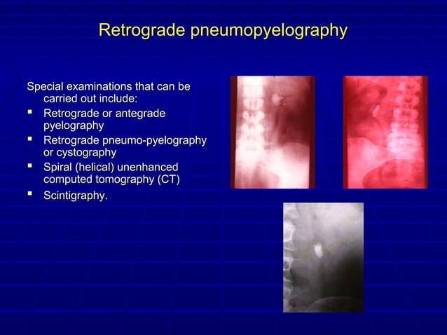 Urinary Stones Disease - Urolithiasis | PPT
