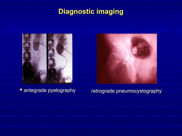 Urinary Stones Disease - Urolithiasis | PPT