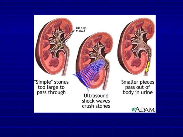 Urinary Stones Disease - Urolithiasis | PPT