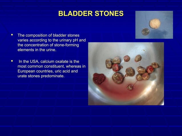 Urinary Stones Disease - Urolithiasis | PPT